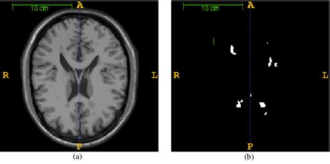 A Axial View Of A T1 Weighted Image With Severe Ms Lesions B