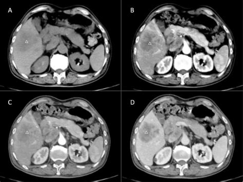 Update On The Diagnosis And Treatment Of Combined Hepatocellular