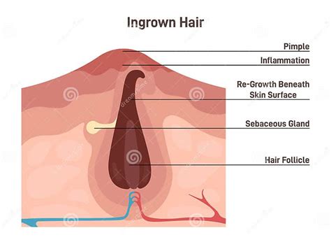 Ingrown Hair Dermatology Problem When Hair Has Grown Back Into The