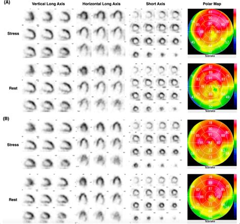 Myocardial Perfusion Scintigraphy Image Showing No Evidence Of New