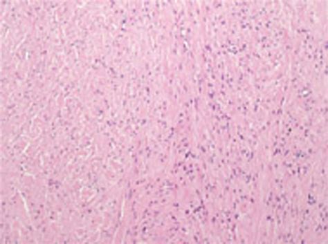 Gigantic Nasal Fibroma Ct And Mr Imaging Findings With