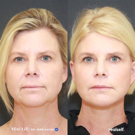 What Does A Mini Face Lift Include At Stephen Levy Blog