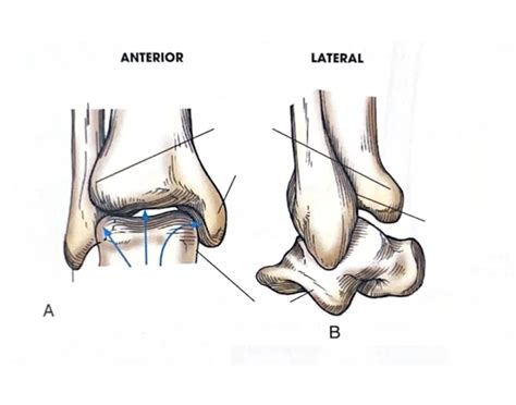 Right Distal Tibia And Fibula Quiz