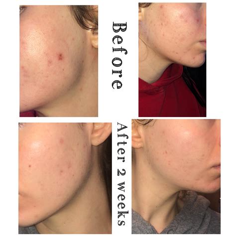 Can I Mix Tretinoin With Lactic Acid At Amy Palmer Blog