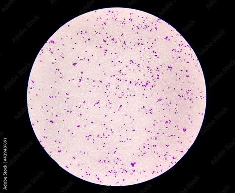 Acute Myeloid Leukemia Aml Is A Type Of Blood Cancer Microscopic