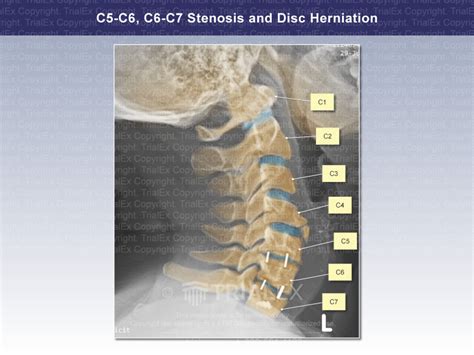 Spine Anatomy C5 C6