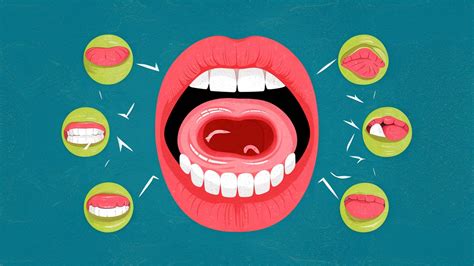 “canker Sores Aphthous Ulcers Types Causes Symptoms And Management”