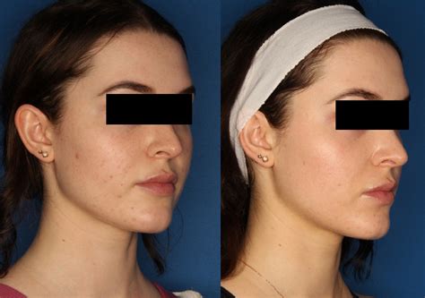 Patient 142681538 Halo® Laser By Sciton Gallery Before And After Photos Laser Cliniqúe