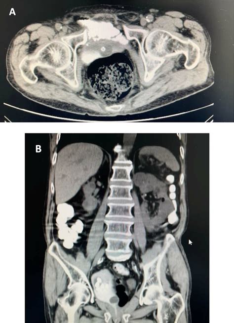 A Ct Scan With Oral Contrast Axial View Revealed Passage Of