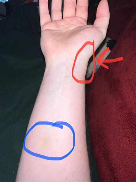 Sprained Wrist Bruising Wrist Sprain Symptoms Treatment In Dallas