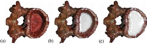 Procedure Of Augmentation Of The Vertebra Body A The Vertebral