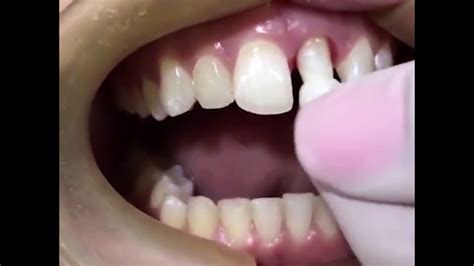 Front Tooth Crown Procedure