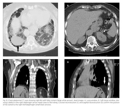 Hernia Diafragmática Posterolateral De Bochdalek En El Adulto