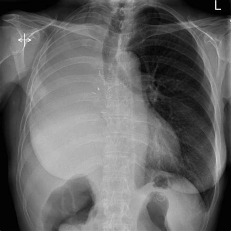 Left Lower Lobe Collapse Cxr Radiology At St Vincents University Hospital
