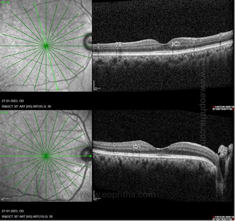 Diabetic Maculopathy Oct
