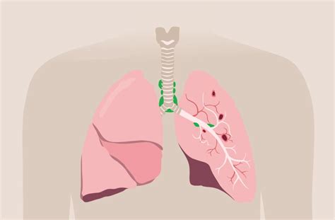 Саркоидоз лёгких причины симптомы диагностика и лечение болезни