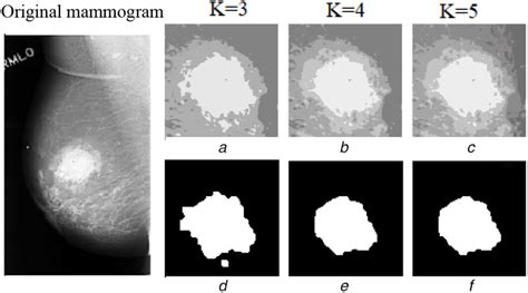 Mammogram Segmentation Results Of Case C‐0051‐1 From The Ddsm Download Scientific Diagram