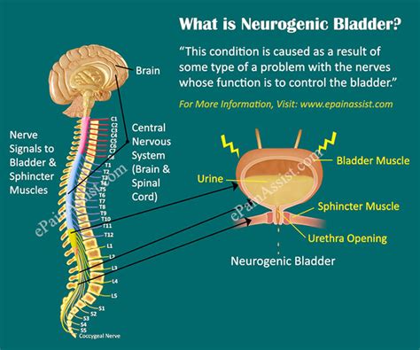 Neurogenic Bladder Causes Symptoms Treatment