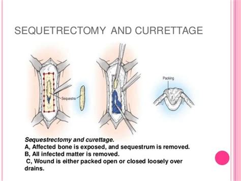 Osteoornmronj Lpoe Flashcards Quizlet