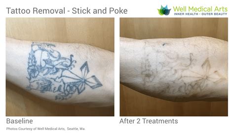 Home Made Tattoo Removal In Seattle At Well Medical Arts