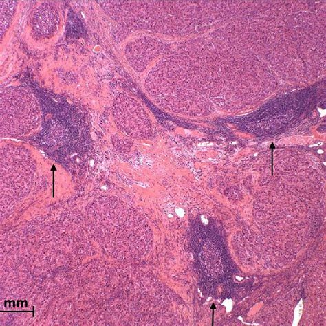 Tertiary Lymphoid Structures Arrows Inside A Surgically Resected