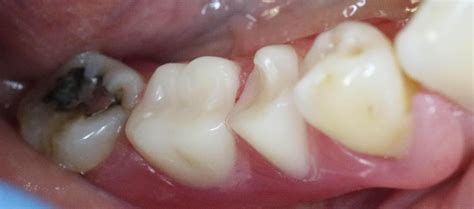 For Few Missing Teeth On One Side Before And After Photos Lewisville