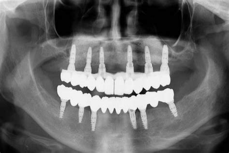 Regeneration Of Horizontal Bone Defect In Edentulous Maxilla Using The