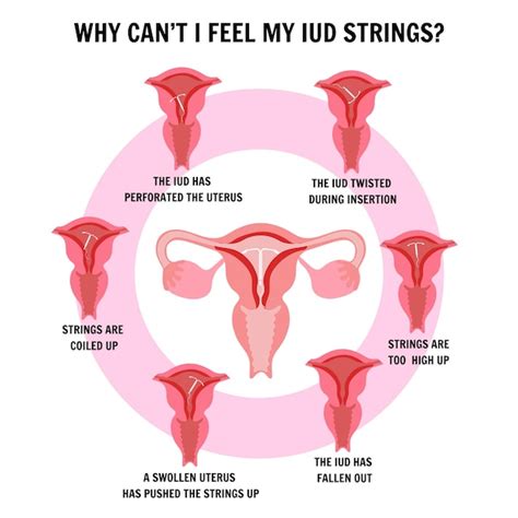 Iud String