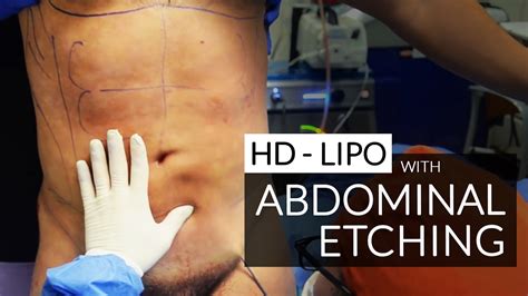 Hi Definition Liposculpture Liposuction Abdominal Etching Six Pack Surgery By Dr Jason