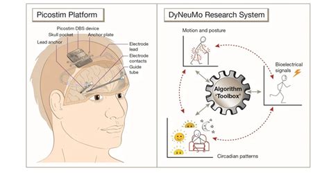 Uks First Pediatric Epilepsy Deep Brain Stimulation Trial Starts Mirage News