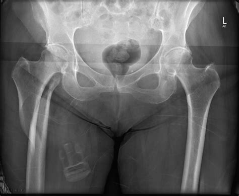 Hip Fractures And Trauma Brisbane Hip Clinic Australia