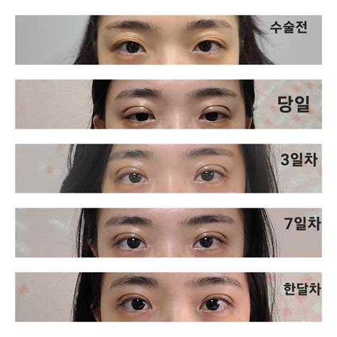 비절개 자연유착 눈매교정 후기 리얼후기 눈이 예쁘다그래서 아몬드성형외과