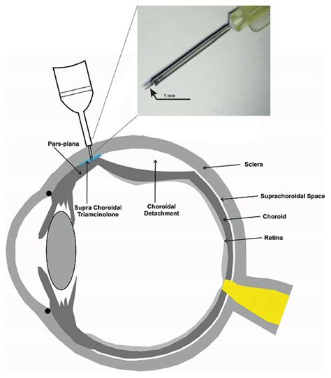 Image Artwork Shows The Injection Technique Into The Suprachoroidal Download Scientific Diagram