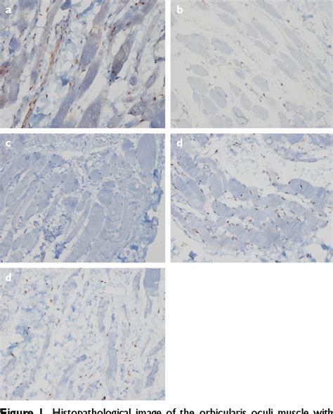 Figure 1 From Histopathological View Of Benign Essential Blepharospasm Orbicularis Oculi