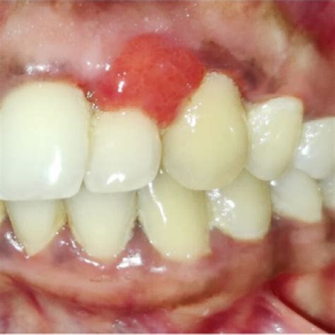 Pdf The Impact Of Sex Hormones On The Periodontium During A Womans