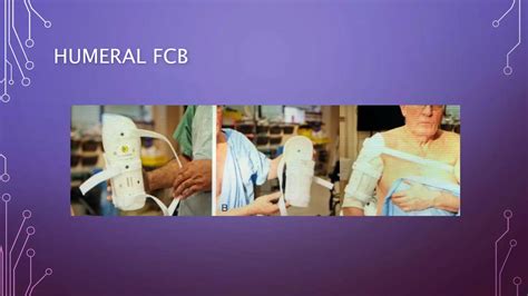 Dr S Senthil Sailesh Functional Cast Bracing Ptbcast Sarmiento