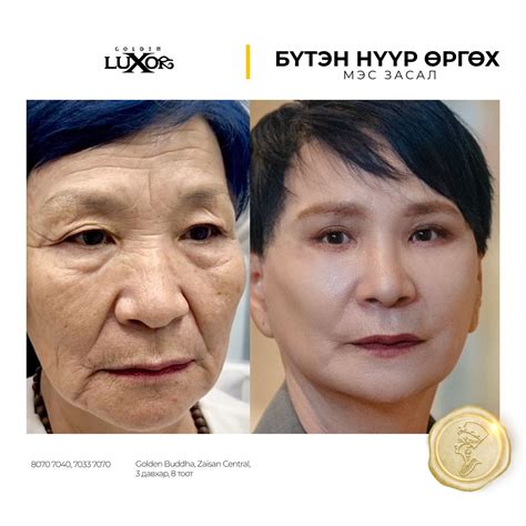 Golden Luxor Beauty Clinic 👩‍⚕️Нүүр өргөх мэс заслын хөнгөлөлтөө