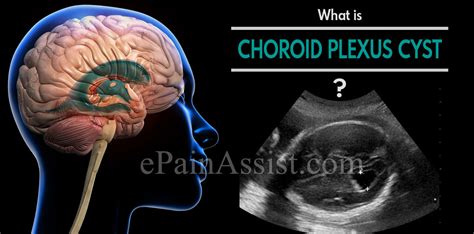 What Is Choroid Plexus Cyst What Is Choroid Plexus Cyst