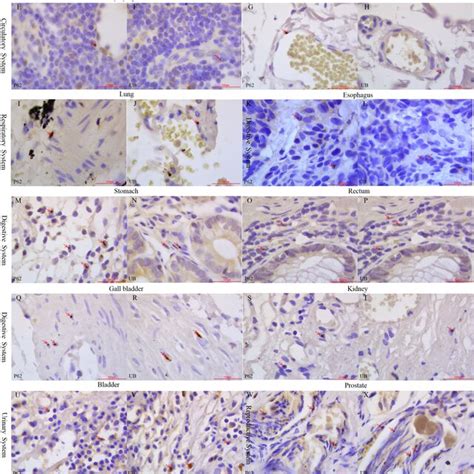 Positive Immunostaining Of Anti‐p62 And Anti‐ubiquitin In Different