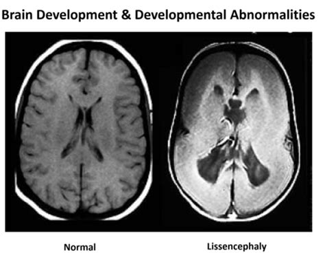 L10 Brain Developmentdevelopmental Abnormalities Flashcards Quizlet