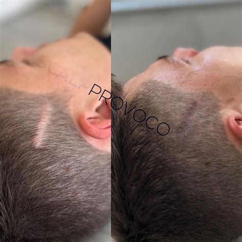 Injury Head Scar Coverage Scalp Provoco Injury Head Scar Coverage Scalp Provoco