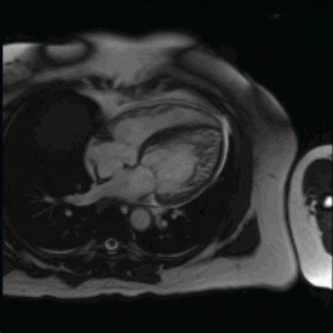Non Compaction Kardiomyopathie Pacs