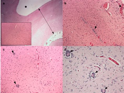 Histopathology A Brain Cerebral Parenchyma Reduced To A Thin Layer Download Scientific