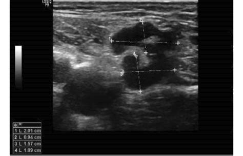 Biopsy Of 2× 94 Cm Right Inguinal Lymph Node Download Scientific Diagram