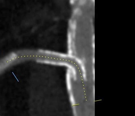 Follow Up Computed Tomography Angiography Download Scientific Diagram