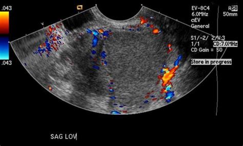 Endometriosis Uterus Ultrasound Ultrasound Imaging