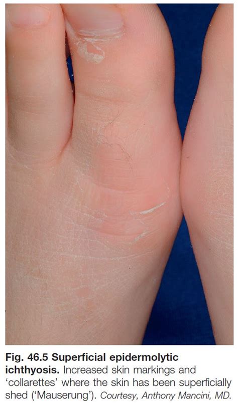 Epidermolytic Ichthyosis