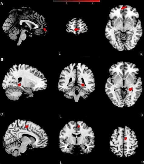 Gray Matter Volume Gmv Divergences Among Groups Attenuated Gmv Download Scientific Diagram