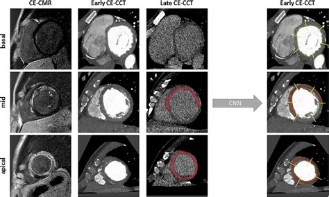 Examples Of Models Classification For A Basal Mid Ventricular And Download Scientific Diagram