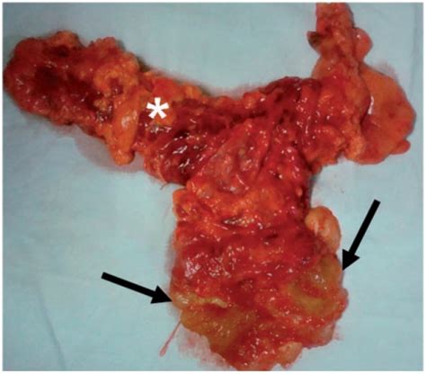 Mucinous Neoplasms Of The Appendix A Current Comprehensive Clinicopathologic And Imaging Review